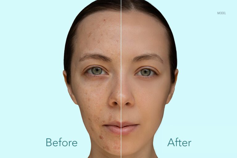 How Do Chemical Peels Treat Acne & Acne Scars? | Leonard Hochstein, MD